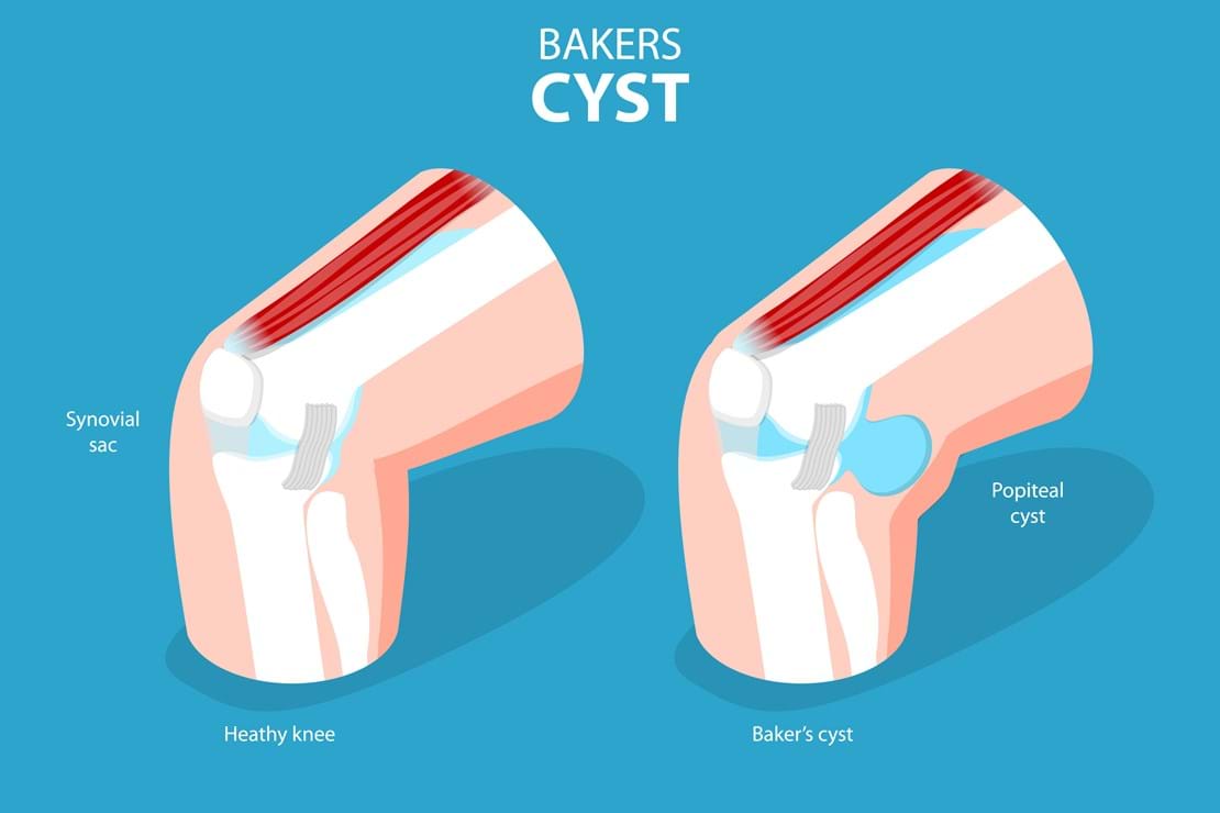 What Is A Bakers Cyst