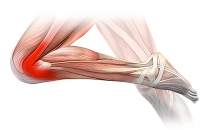 Can physiotherapy help with ITB pain in runners?