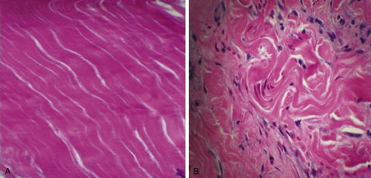 How to fix tendon pain?